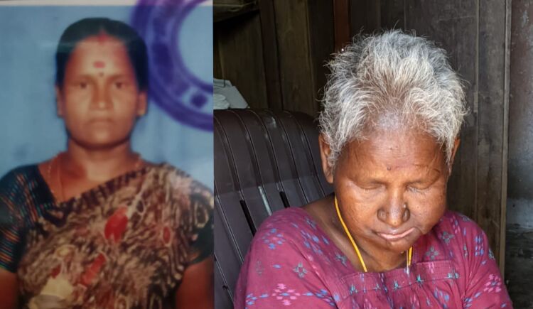 Kalaiselvi’s Fight Against Stage 2 Oral Cancer Needs Your Support! - Ketto