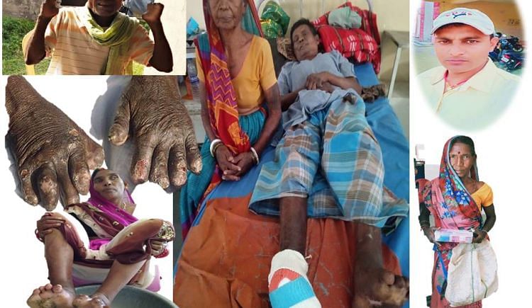 Contribute To Leprosy / Kushth Patients. - Ketto