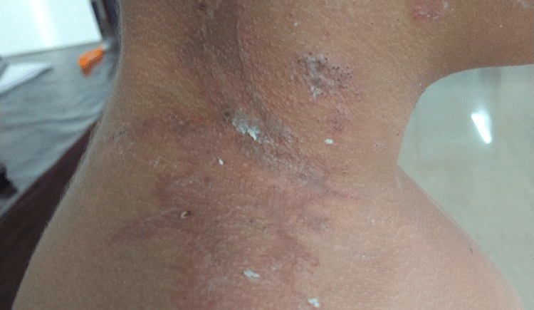 My Son Is Suffering From Fungal Cns Infection. We Need Your Help To ...