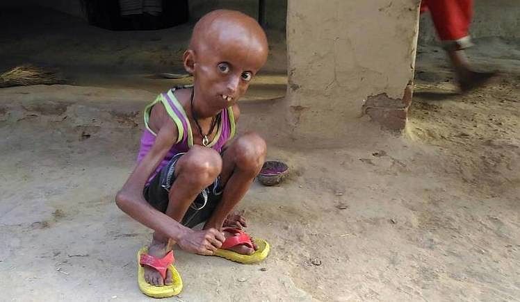 Real Life Benjamin Button, Rupesh Pleads For Help - Ketto