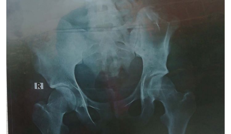 Offer A Helping Hand To Support Md Sadaf 's Treatment - Ketto