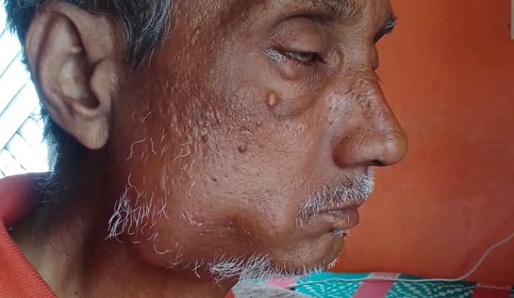 Offer A Helping Hand To Support Sanjay Basak's Treatment - Ketto