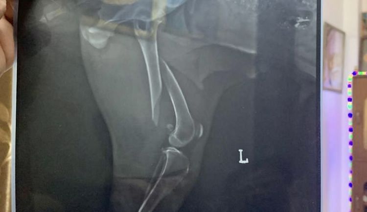 Malnourished Mother For Her Femur Left Leg Surgery - Ketto