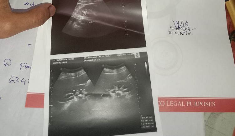 My Mother Is Suffering From Bilateral Renal Calculi, Right Renal PUJ ...