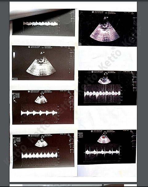 Help Us Save Baby Rukaya! - Ketto