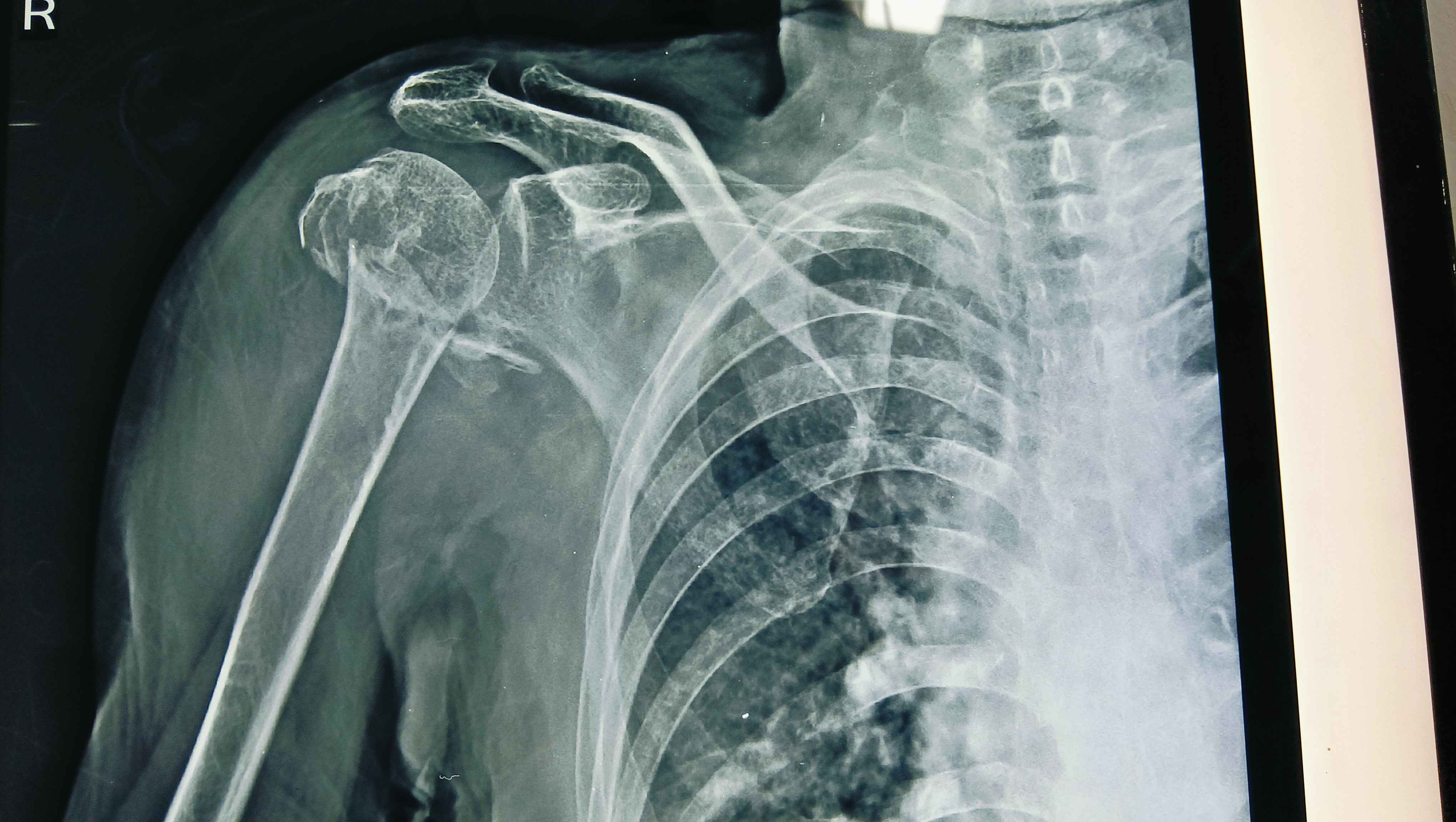 My Mother Is Suffering From Humorous Shoulder Bone Fracture We Need ...