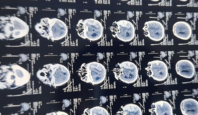My Grandfather Is Suffering From Intracerebral Hemorrhage (ICH ...