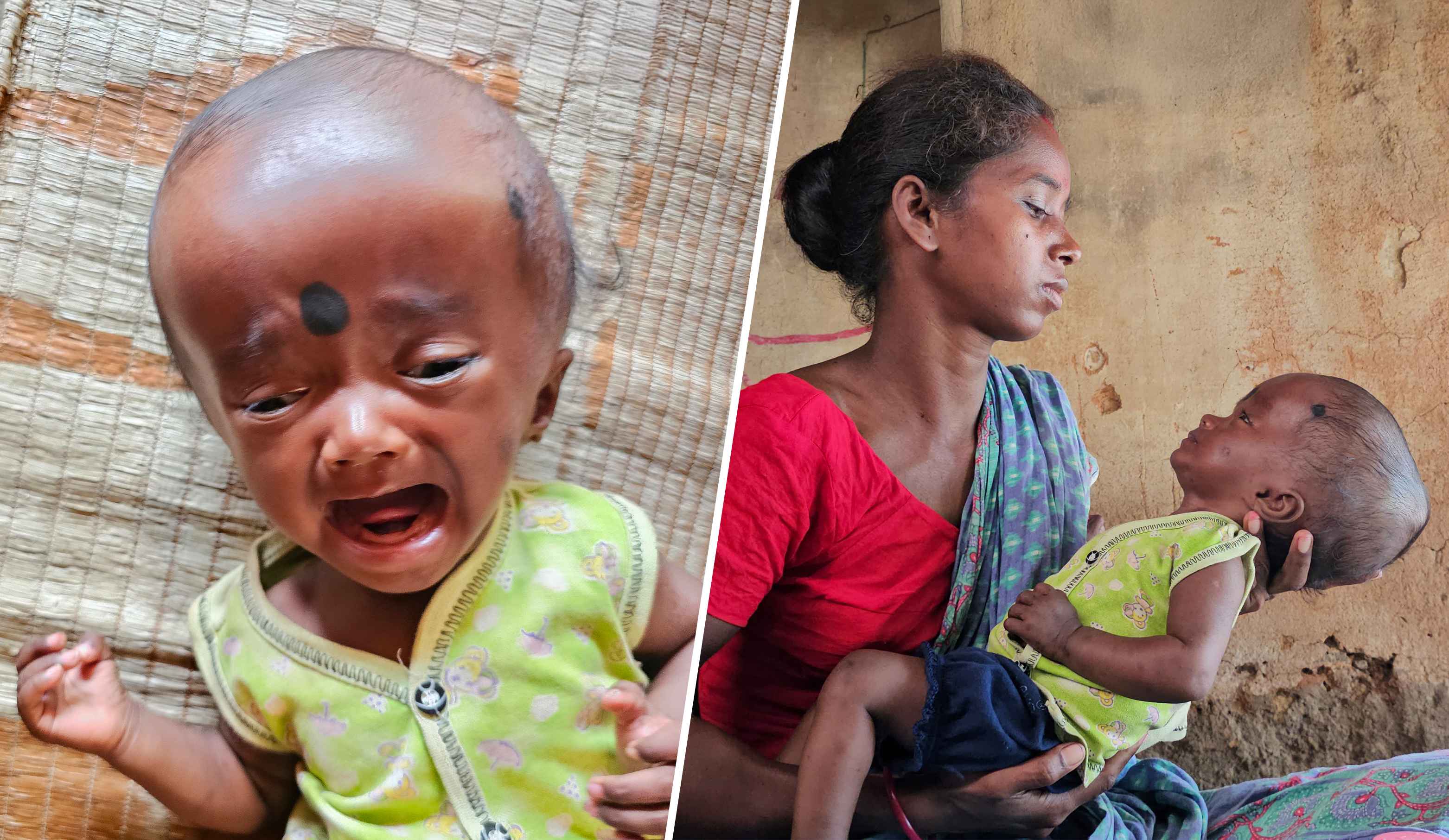 Help! This 5-month-old Baby Needs Urgent Surgery For A Severe Head ...