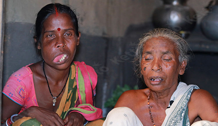 Ramni Begs For Your Support In Her Battle For Healing & Dignity! - Ketto