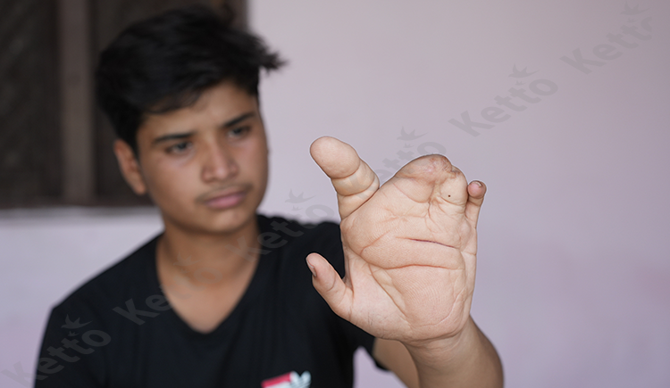 My Son Was Born With A Deformed Hand, Your Support Can Help Him! - Ketto