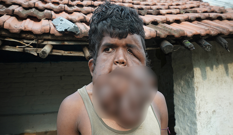 A Rare Condition Has Left Raj With A Severely Disfigured Face. Help Him ...